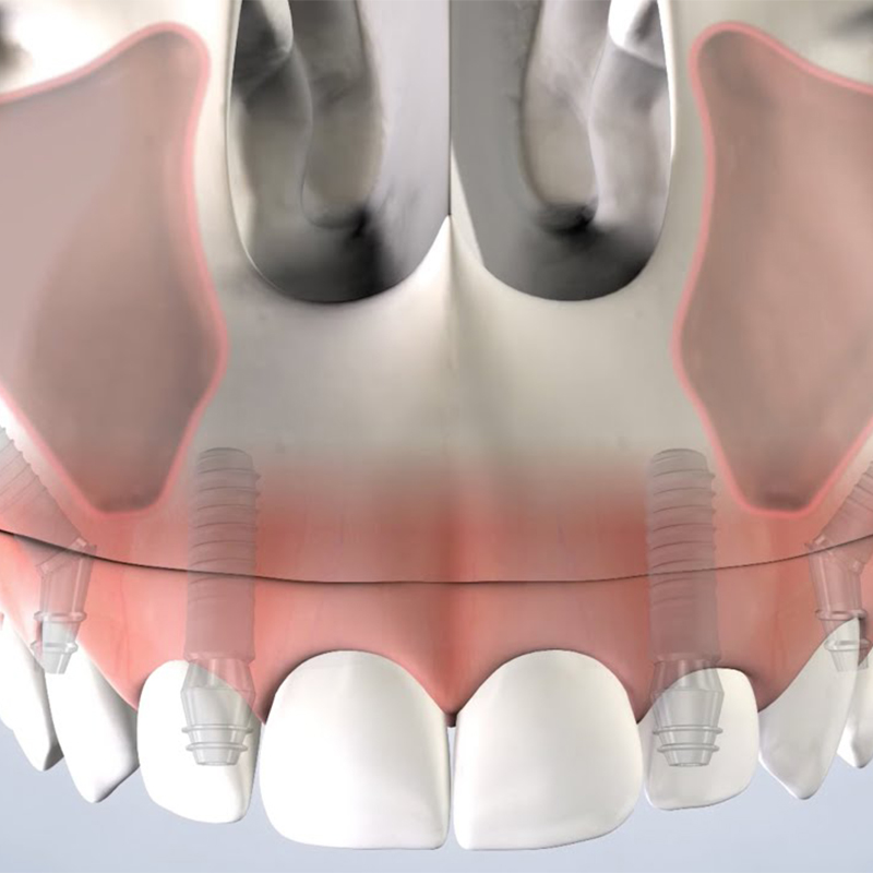 Zygomatic Dental Implants: The Ultimate Solution for Advanced Bone Loss ...